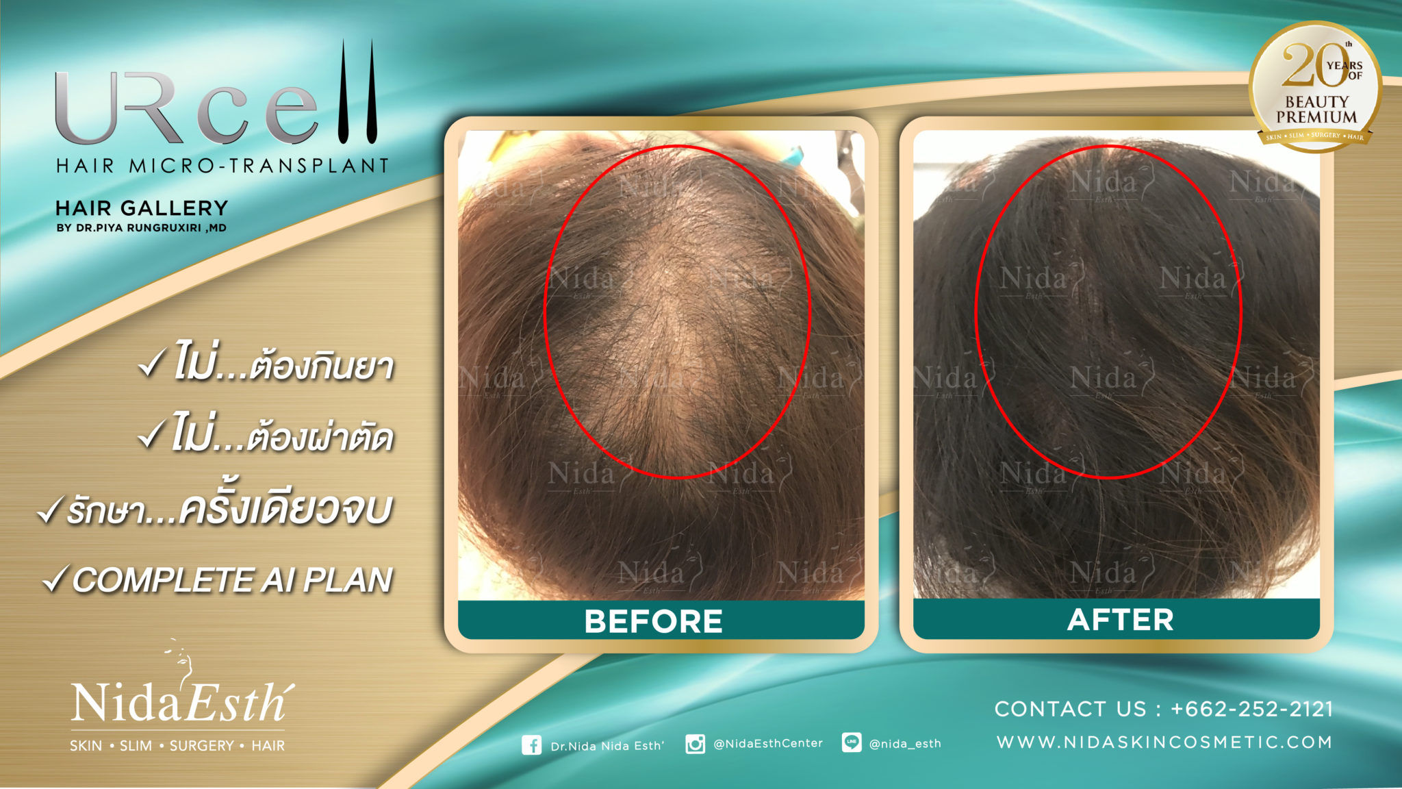 ปลูกผมด้วยเซลล์คุณเอง UR Cell Hair Micro Transplant+ เทคนิคใหม่!