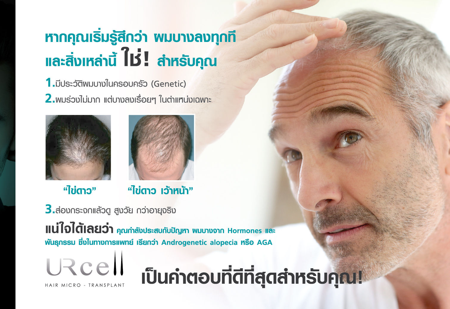 ปลูกผมด้วยเซลล์คุณเอง UR Cell Hair Micro Transplant+ เทคนิคใหม่!