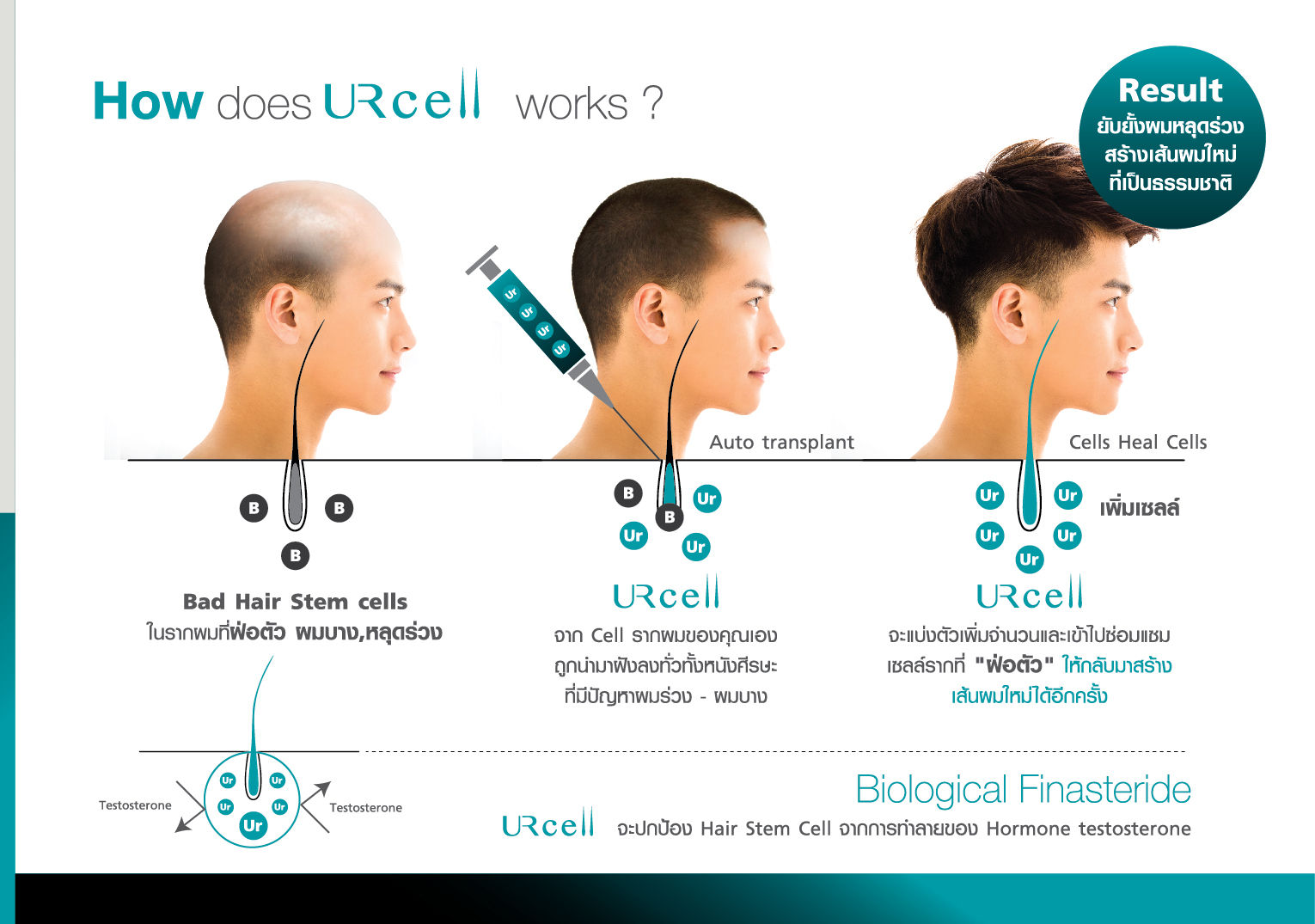 ปลูกผมด้วยเซลล์คุณเอง UR Cell Hair Micro Transplant+ เทคนิคใหม่!